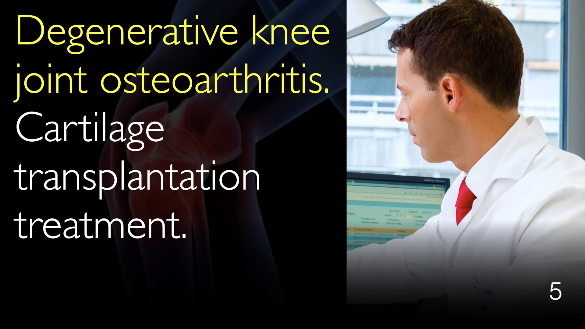 Degenerative knee joint osteoarthritis. Cartilage transplantation trea ...